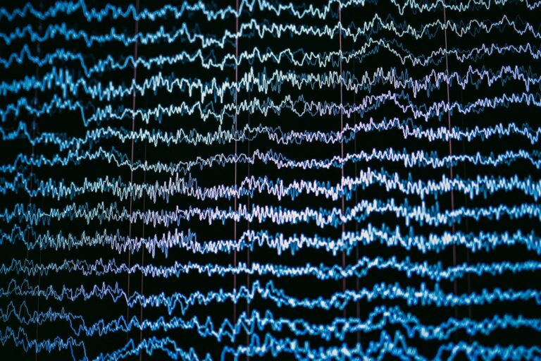 Interpreting EEG for Anesthesia Monitoring - Wisconsin Anesthesia