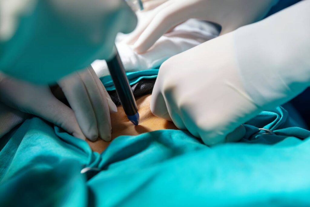 Nerve Blocks in the Abdomen